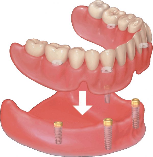 Locator – Shared Implantology gmbh